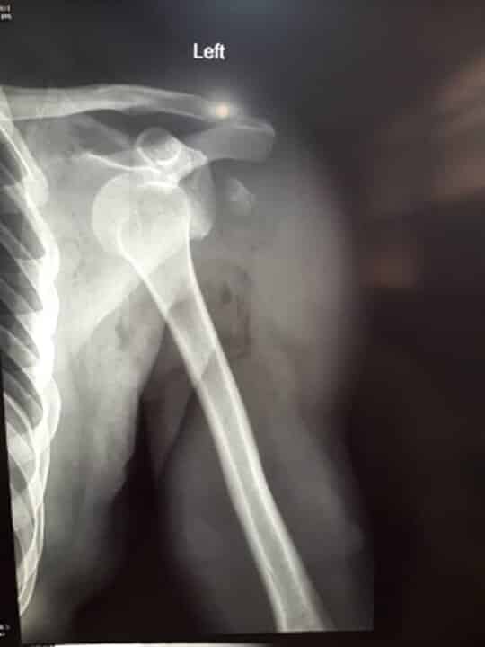 Axillary artery compression following reduction of a high-impact ...