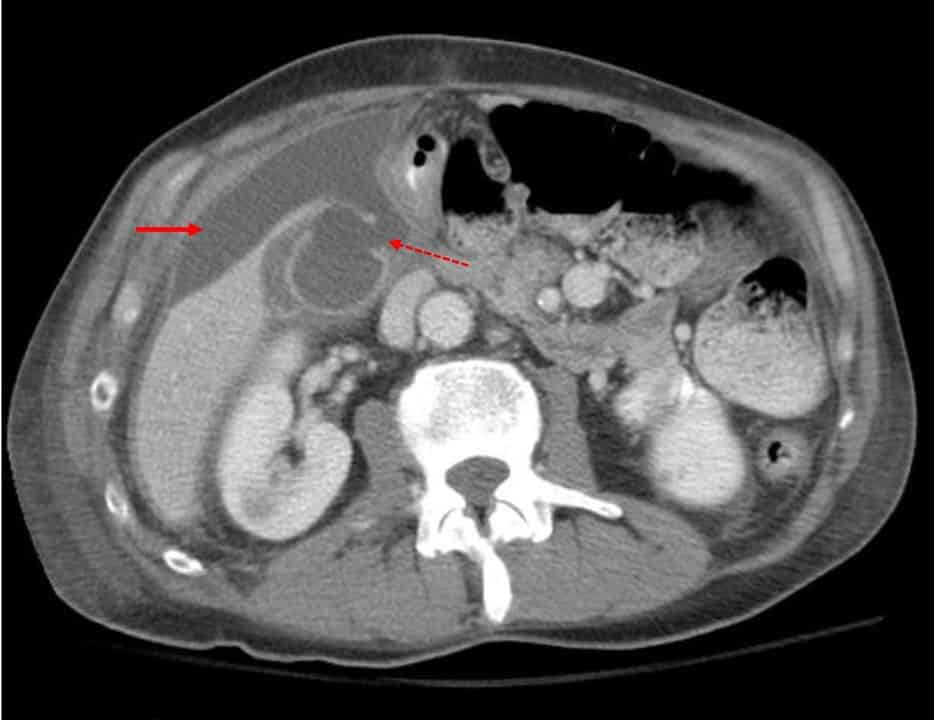 An overview of the management of gallbladder perforations. | Published ...