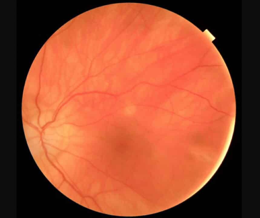 A Case Report: Diagnosing Arteritic Anterior Ischemic Optic Neuropathy ...