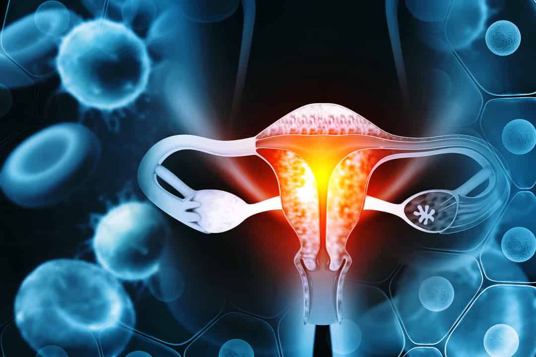 Evolving Treatment Landscape in Endometrial Cancer | Published in healthbook TIMES Oncology ...