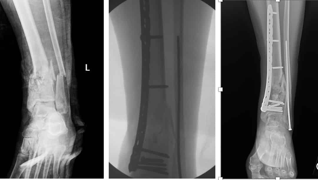 Intramedullary Screw Fixation of Distal Fibula Fractures: A Surgical ...