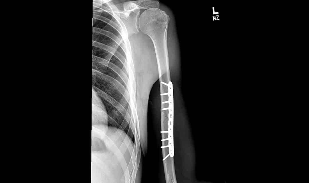 Single-Plate versus Dual-Plate Utilization for Treatment of Humeral ...