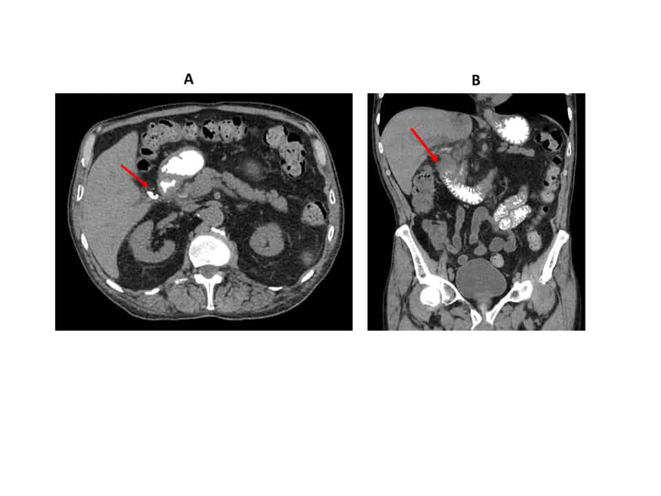 Lyme carditis complicating the presentation of a perforated duodenal ...