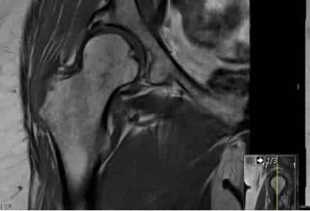 Avascular Necrosis and Subchondral Collapse of the Femoral Head After ...