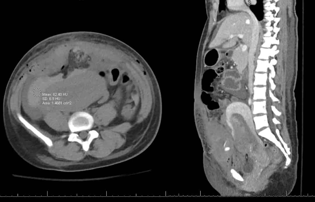 Rectus Abdominis Sheath Hematoma Following Cesarean Section: A Case ...