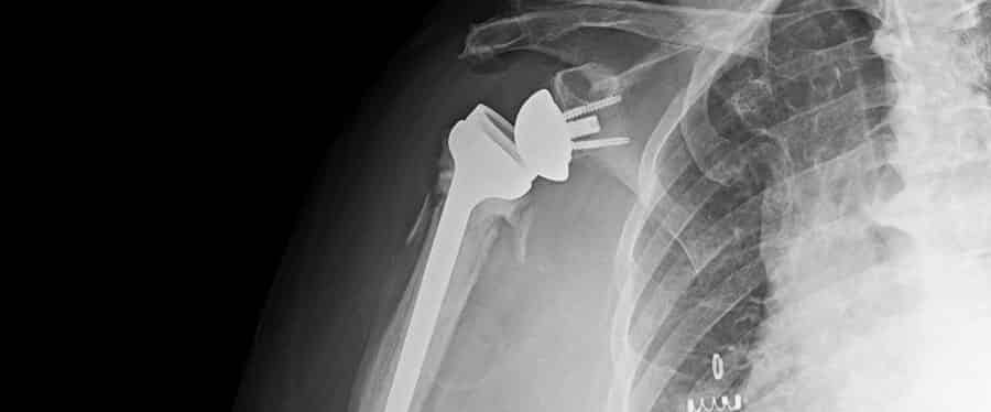 Glenoid-Anchor Cerclage for the Unstable Reverse Shoulder Arthroplasty ...