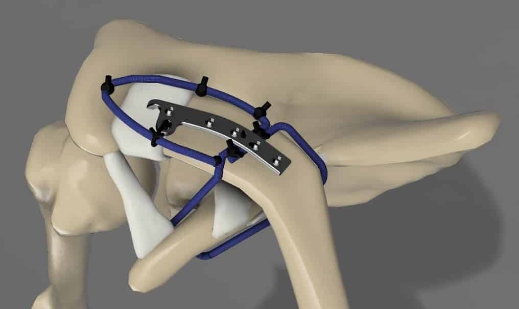 Reconstruction of chronic acromioclavicular dislocation with ...