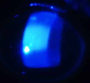 A Case Series of Geographic Corneal Epithelial Defects Secondary to ...