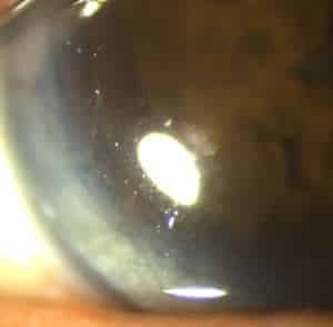 Multiple Intraocular Metallic Foreign Bodies After Phacoemulsification ...
