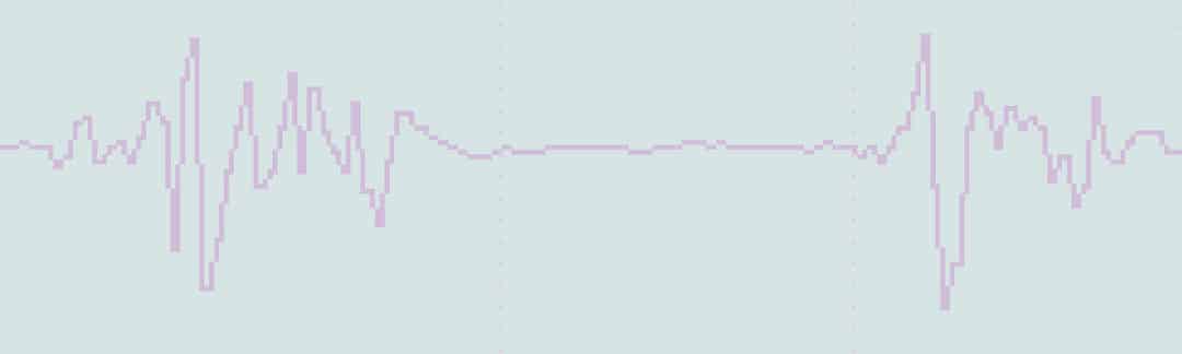 Silent Periods during Mastication Reveal Interfering Tooth Contacts ...