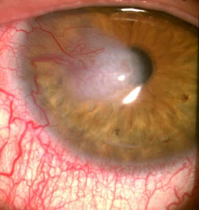 Point-Counter Point: Treating Corneal Haze with 0.8 mg/mL Topical ...