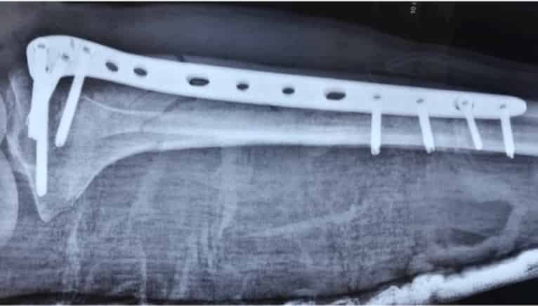 Gravity-Based Minimal Invasive Plate Osteosynthesis for Proximal Tibia ...