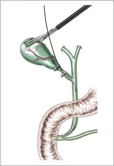 Are we ready for Common Bile Duct Exploration to be a regular part of ...