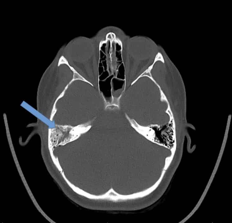 A Rare Case of Acute Otitis Media Complicated by Mastoiditis with ...