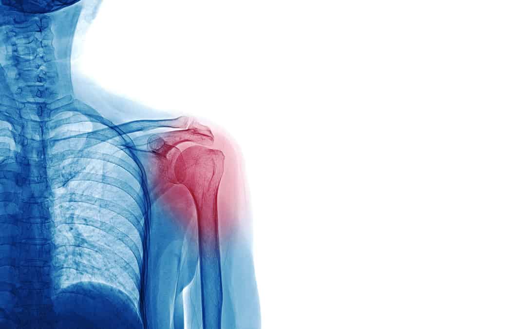 Surgeon Ergonomics During Arthroscopic Shoulder Surgery | Published in ...
