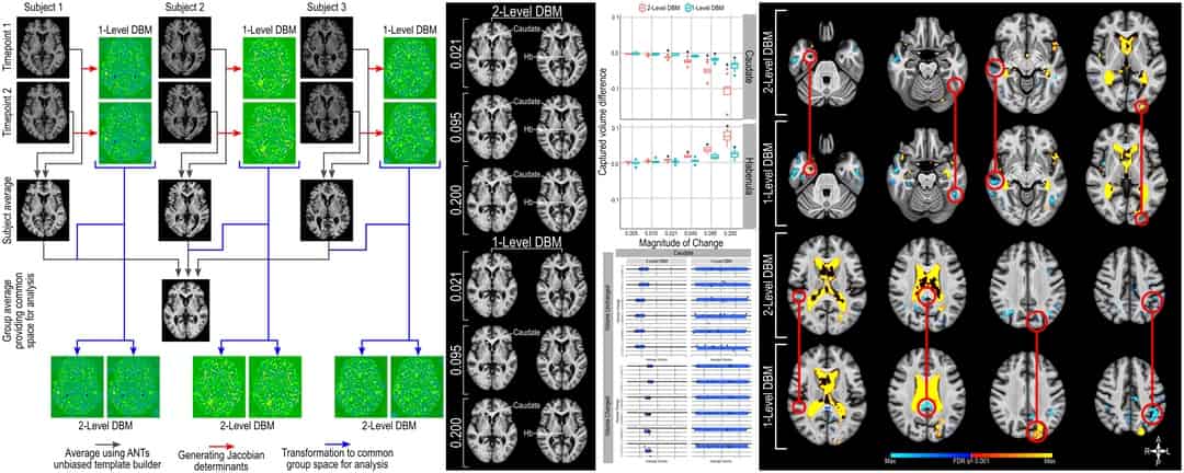 Longitudinal deformation-based morphometry pipeline to study ...