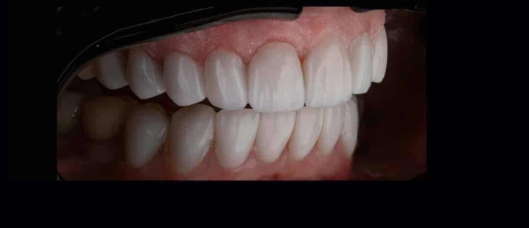 Developing a standardized approach for bite mark identification ...