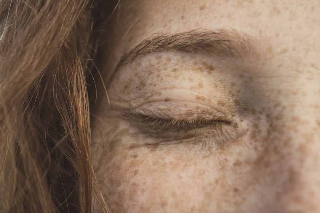 Congestive Heart Failure and Skin Cancer Risk: A Cross-Sectional ...