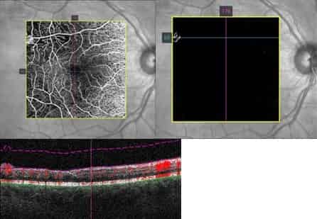 Point-Counterpoint: Can Optical Coherence Tomography Angiography ...