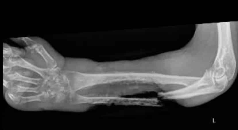 Philadelphia Consensus on the Surgical Management of Xylazine ...