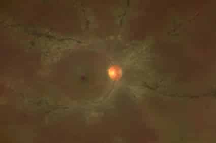 Case Report: Unraveling Pigmented Paravenous Retinochoroidal Atrophy ...