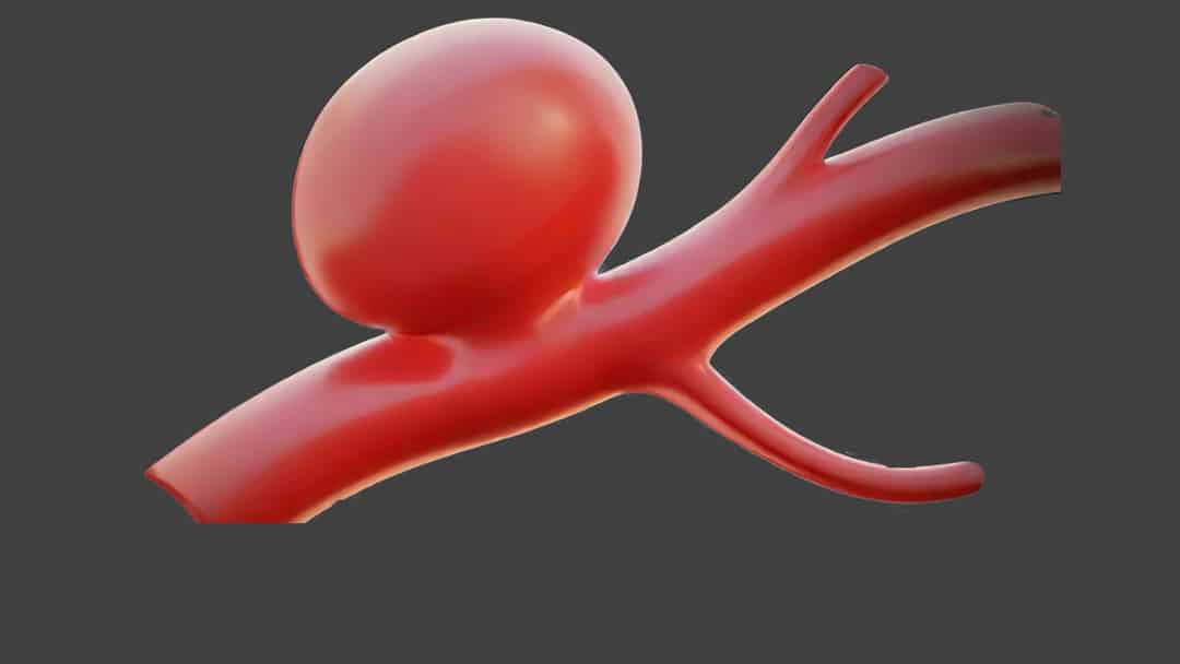 Unraveling the uncertainty of cerebral aneurysms: challenges in ...