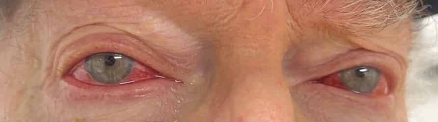 Case Report: VEXAS Syndrome Expands the List of Systemic Diseases ...