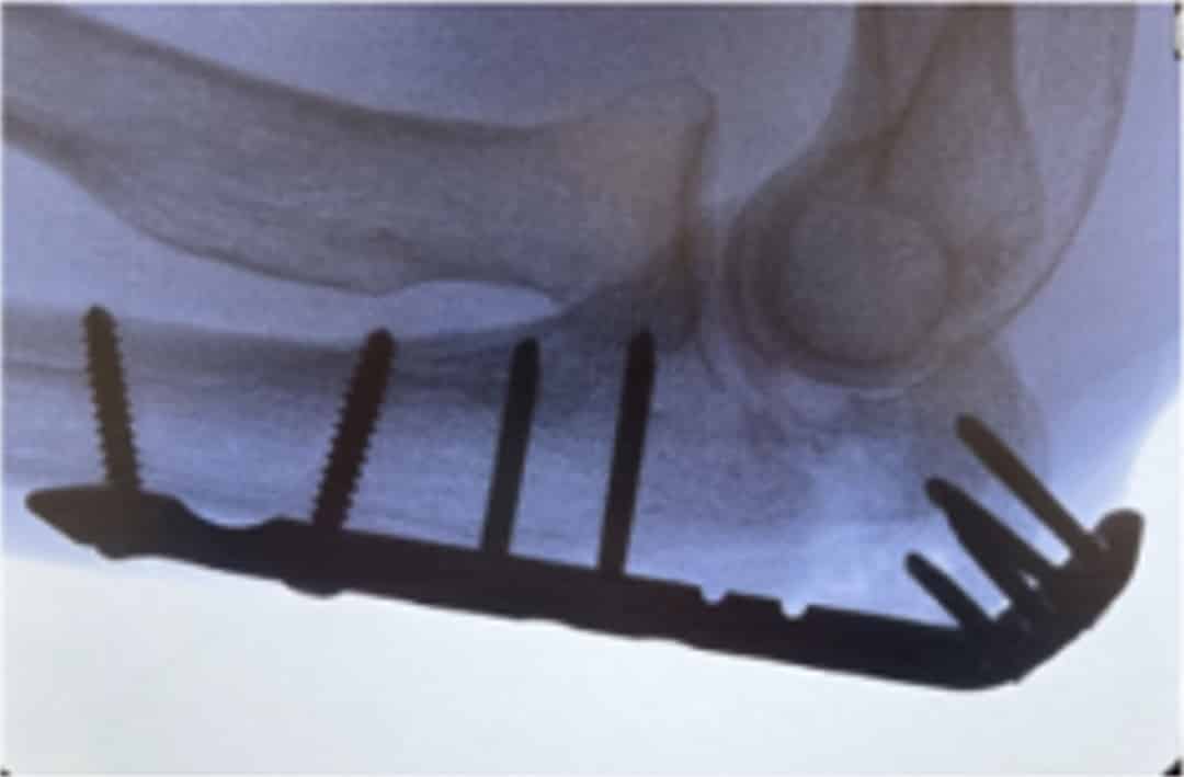 Olecranon Fracture Hardware Removal Trends in Plate and Screw vs Other ...