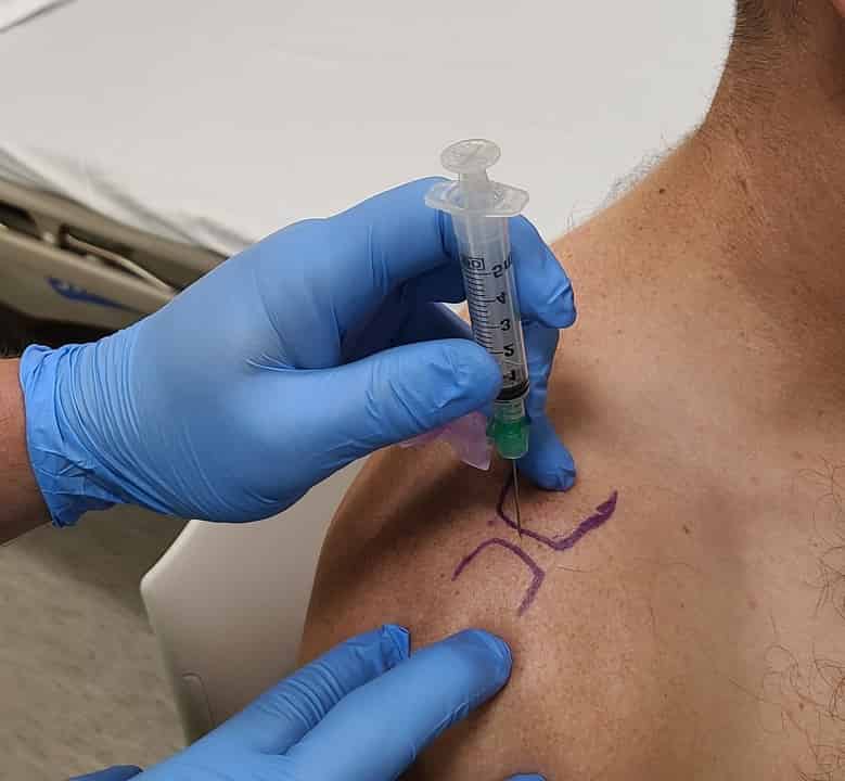 Acromioclavicular Joint Injections: Comparing Joint Identification ...