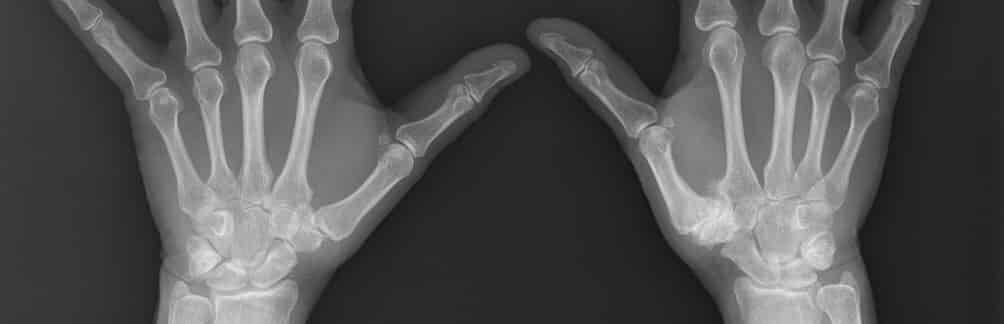 Letter to the Editor Regarding: First Carpometacarpal Joint Arthritis ...