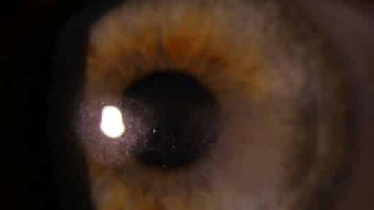 Case Report: Interstitial Keratitis in a Patient With Past History of ...