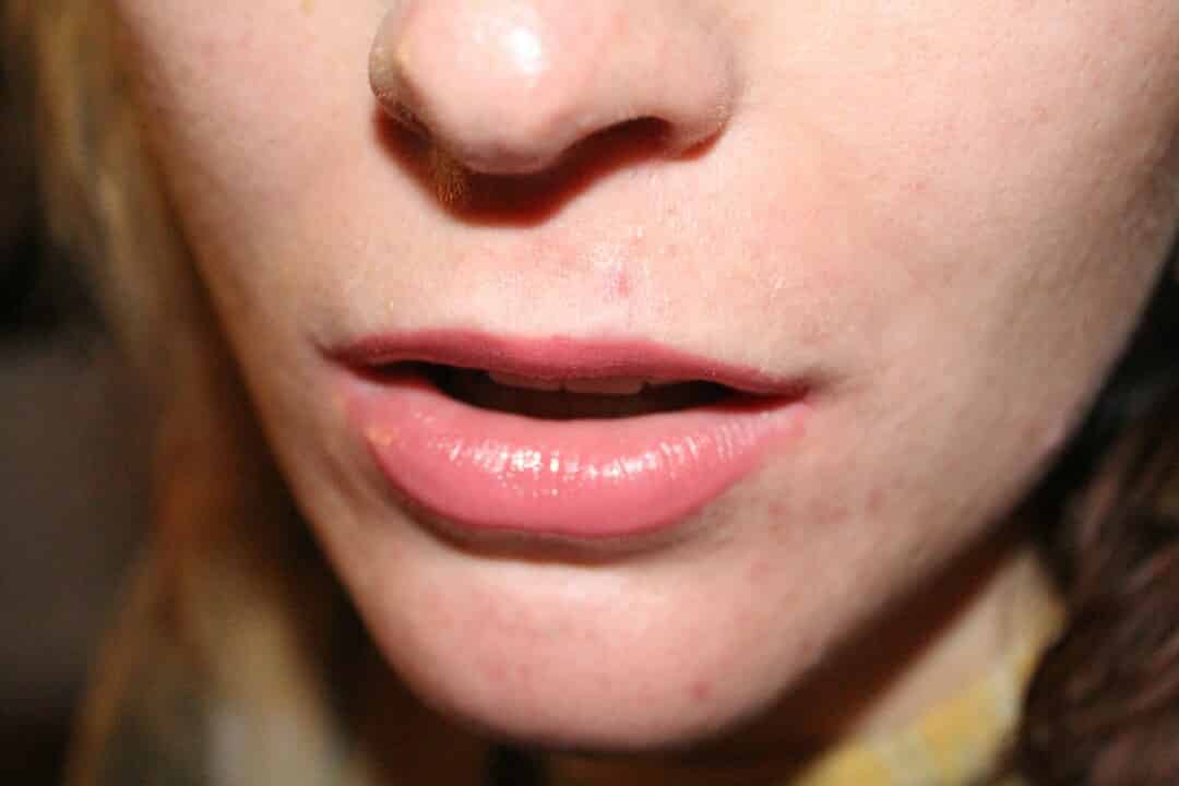 Management of Lip Paraesthesia post Root Canal Treatment via Unilateral ...