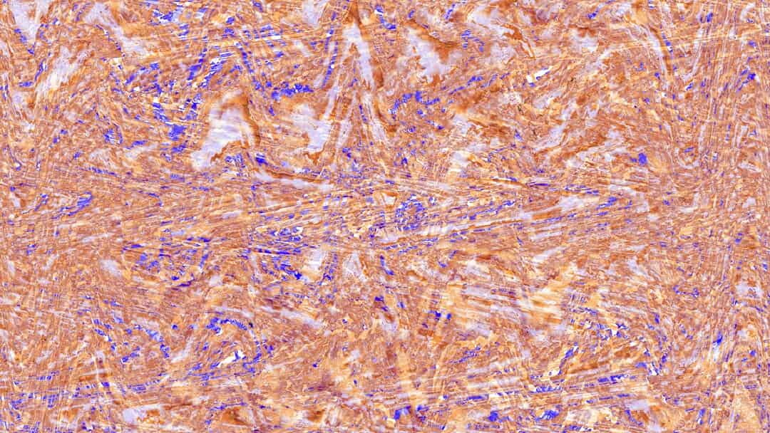 Emerging Modalities that Support Differential Diagnoses of Creutzfeldt ...