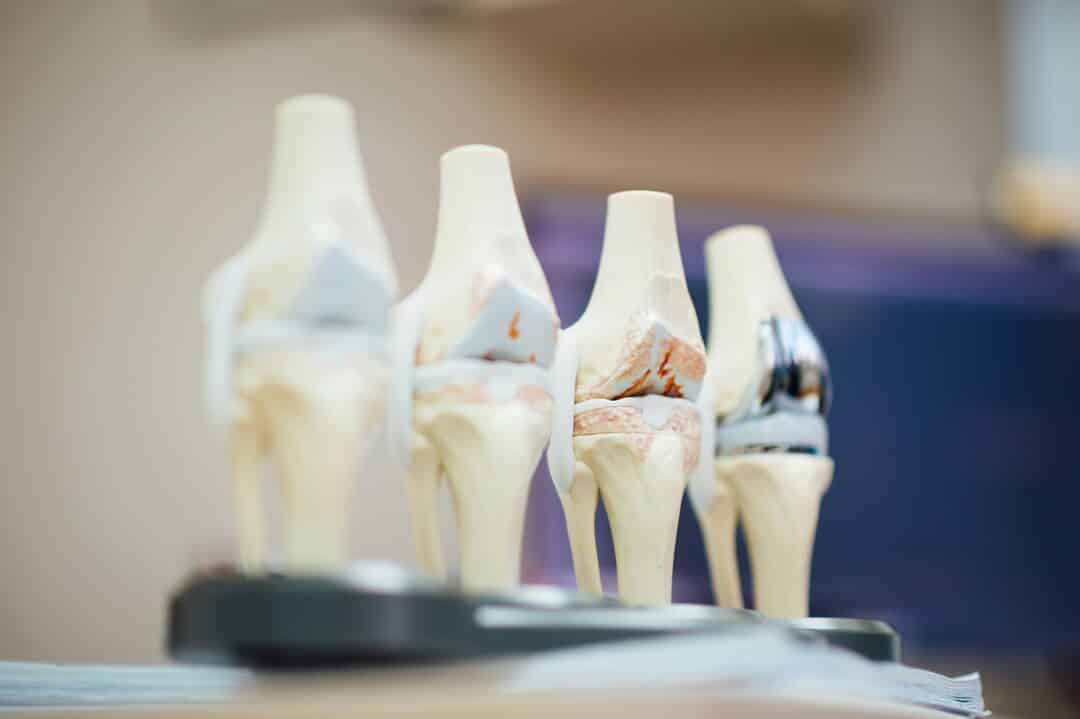 Total Knee Arthroplasty Rehabilitation Strategies for Avoiding ...