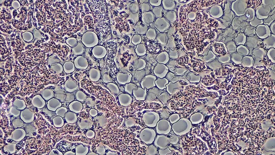 A case of parathyroid crisis presenting with multisystem injury and ...