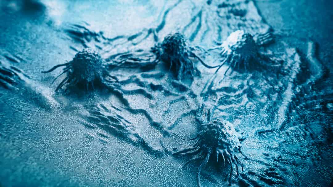 Co-occurrence of angioimmunoblastic T-cell lymphoma and aggressive ...