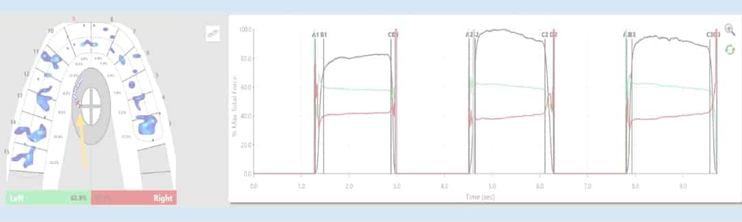 Measuring Change in First Occlusal Contacts from AM to PM with a ...
