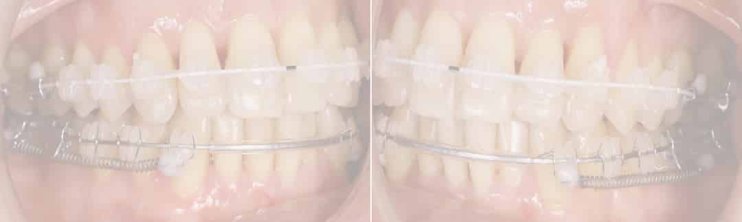 Rationale for the Use of T-Scan Occlusal Analysis in Orthodontics ...