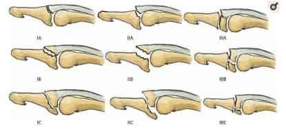 Mallet fractures: a prospective comparison of treatment outcomes ...