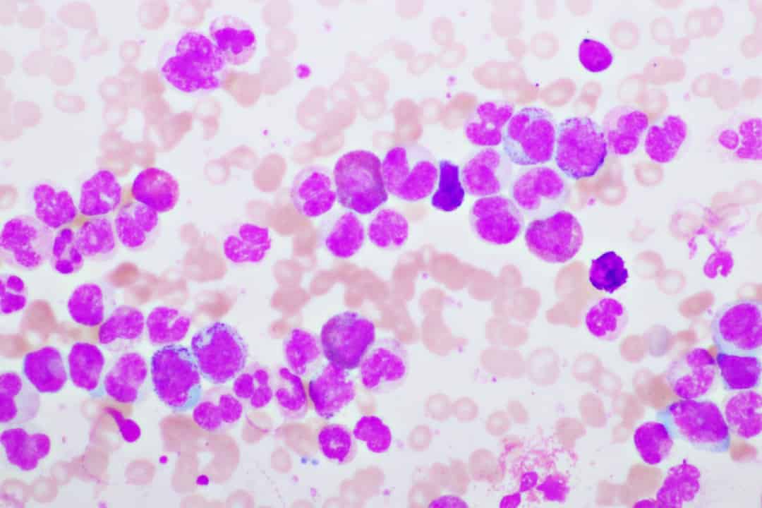 The Evolving Treatment Landscape of AML | Published in healthbook TIMES ...