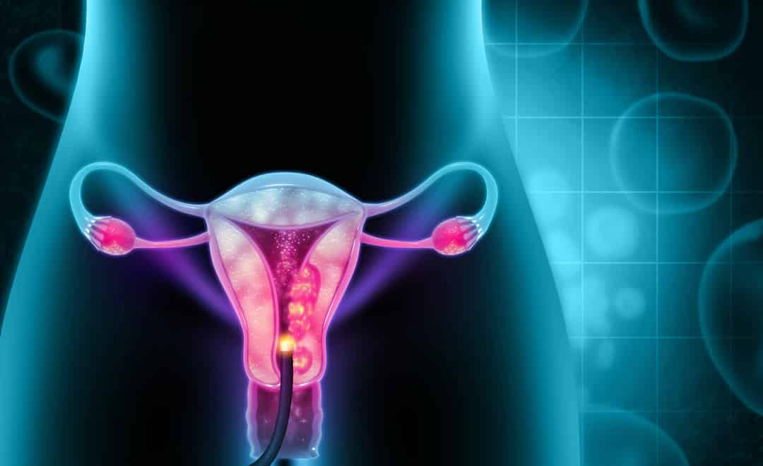 From New Molecular Insights to New Treatment Options in Endometrial Cancer | Published in ...