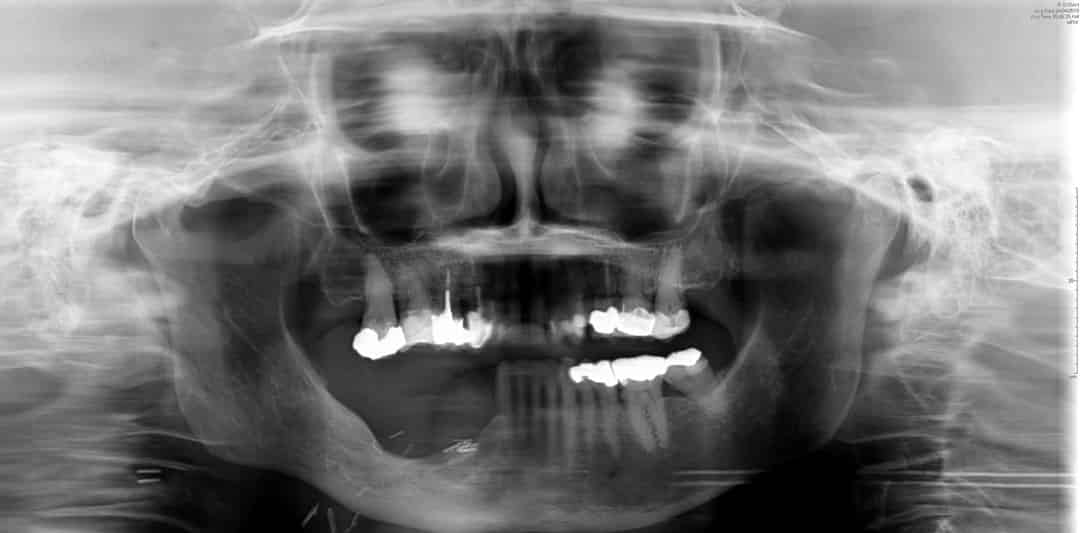 Vascularised periosteal free flap reconstruction for medication-related ...