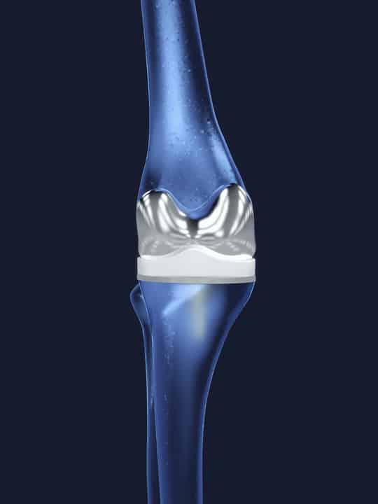 Customized Individually-Made and Conventional Total Knee Implants are ...