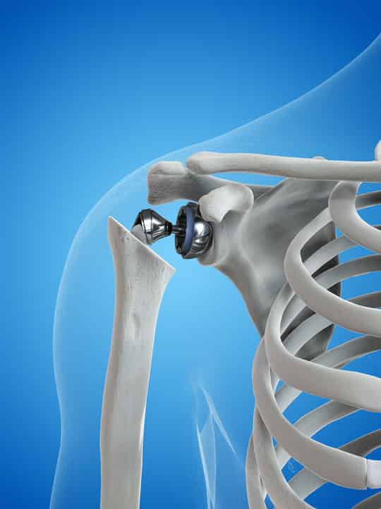 Stemless Shoulder Arthroplasty for Glenohumeral Arthritis with ...