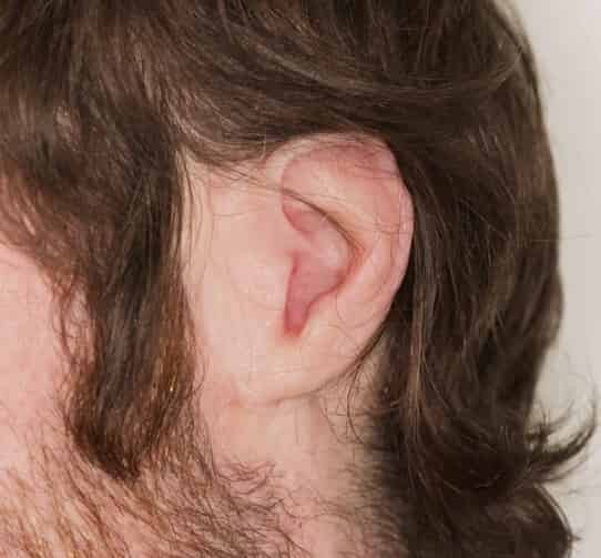 Prosthetic rehabilitation of unilateral congenital microtia with ...