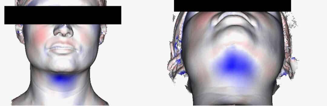 ATX-101 (deoxycholic acid injection) in submental fat reduction: an ...