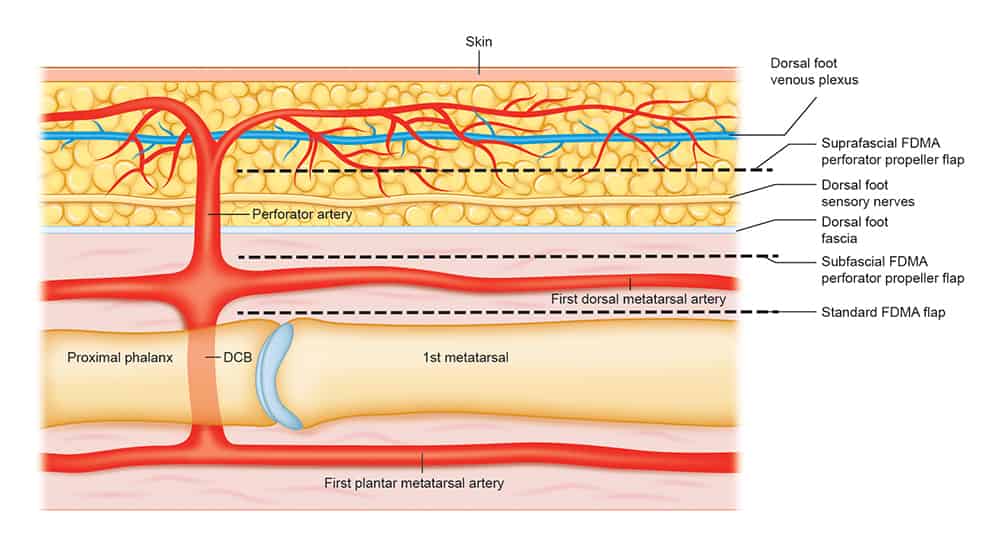 Suprafascial first dorsal metatarsal artery perforator propeller flap ...