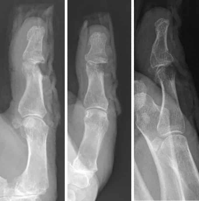 Single-stage kite flap, tendon transfer and arthroplasty in a thumb ...