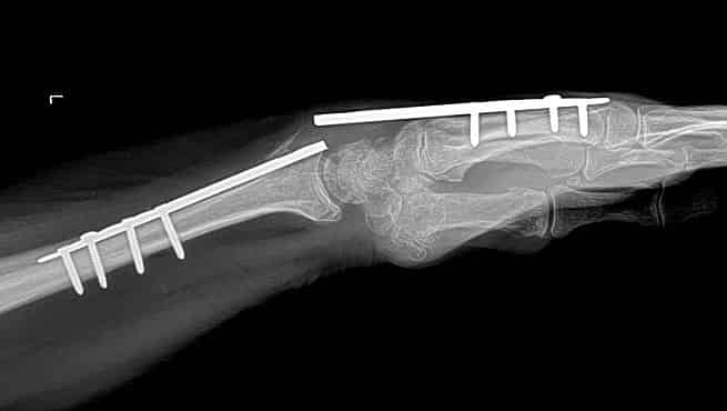 Fatigue Failure of a Distal Radius Dorsal Spanning Locked Bridge Plate ...