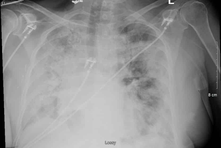 An Unwelcome Guest: The Appearance of Meropenem-Resistant Myroides ...